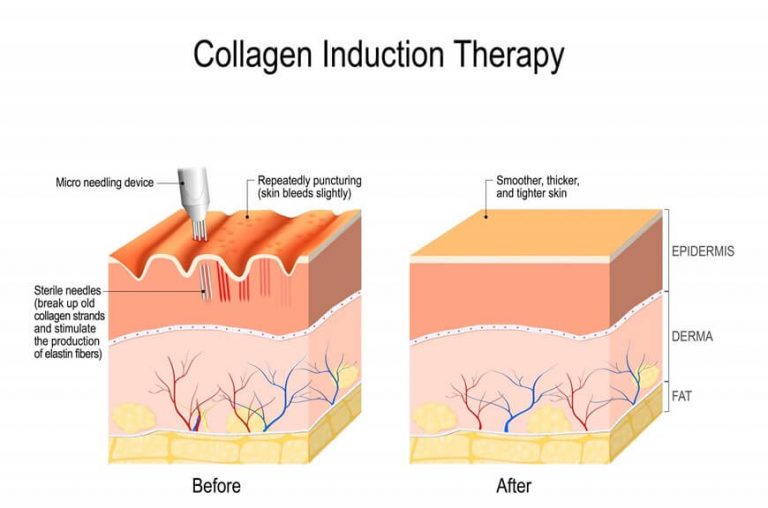 Skin Care - Electrolysis 100% Permanent hair removal