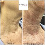 Skin Care - Electrolysis 100% Permanent hair removal
